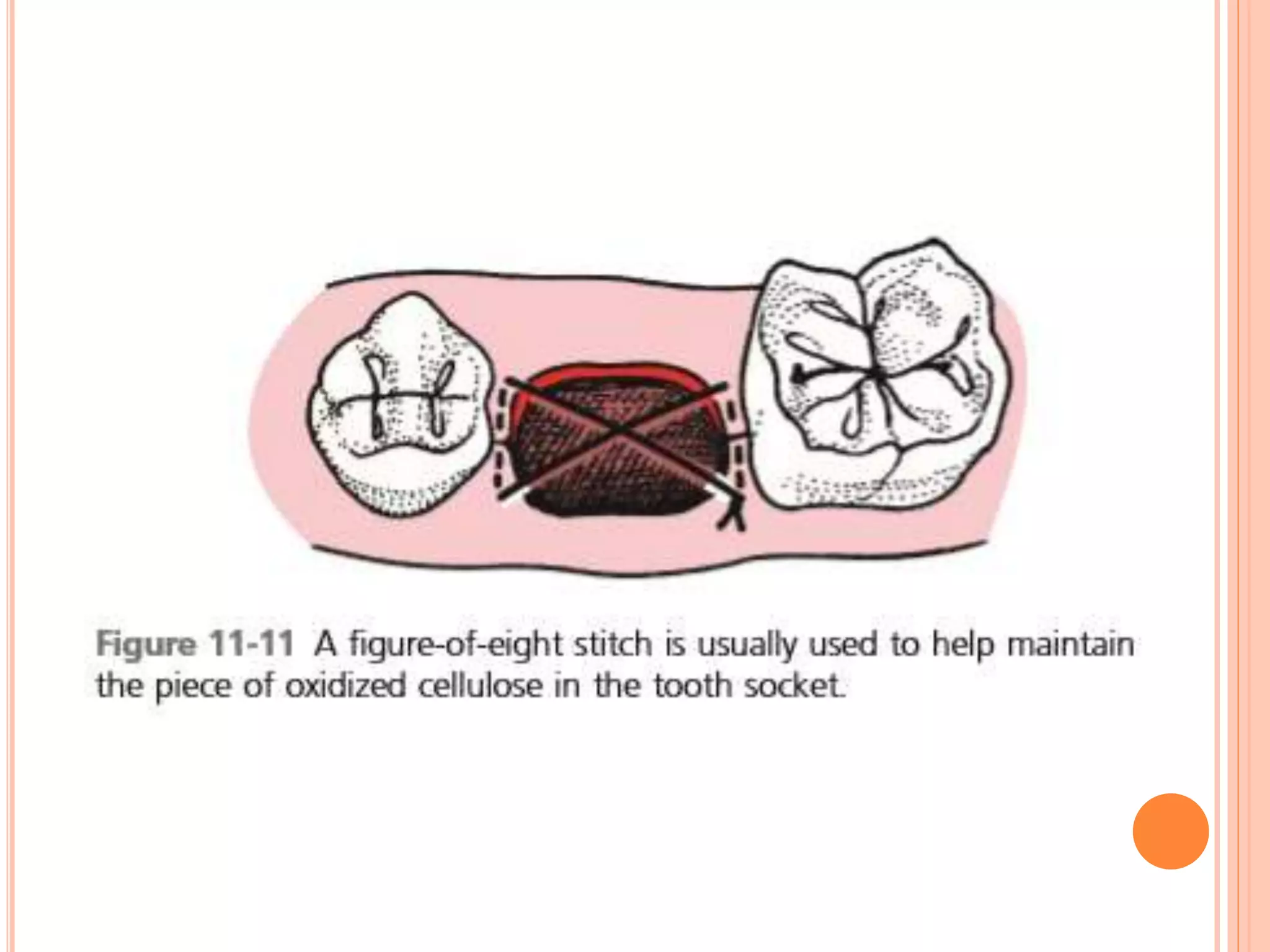 Management of-extraction-complications | PPSX