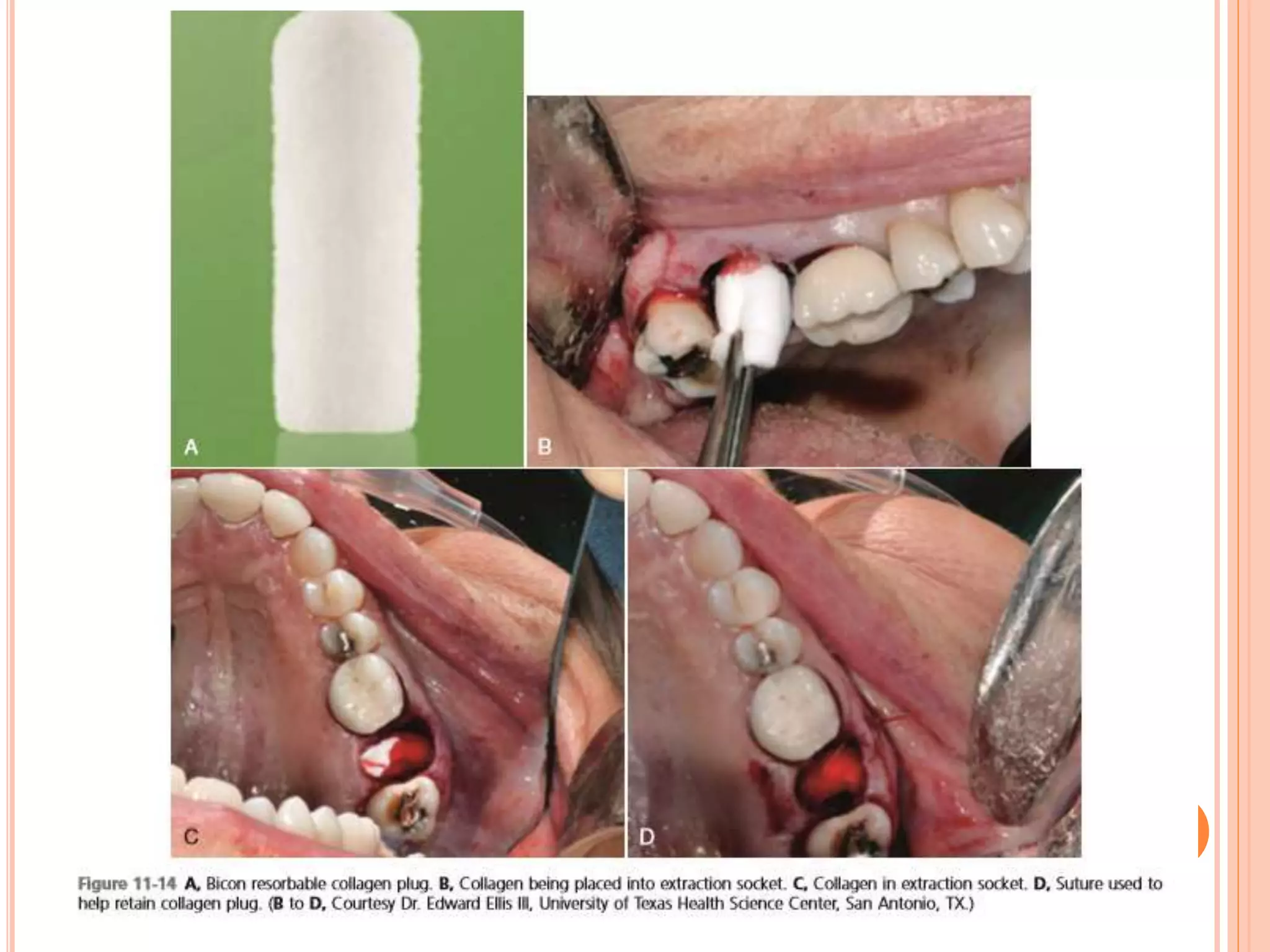 Management of-extraction-complications | PPSX