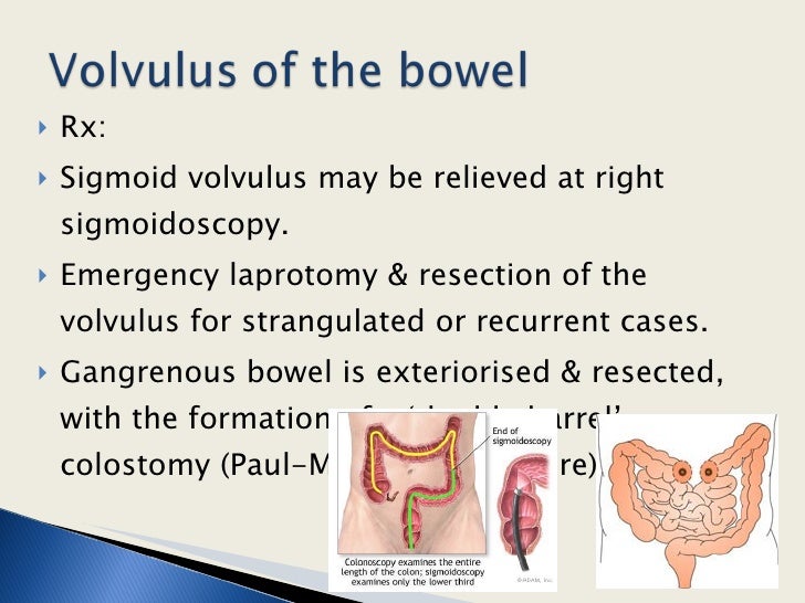 Management Of Intestinal Obstruction
