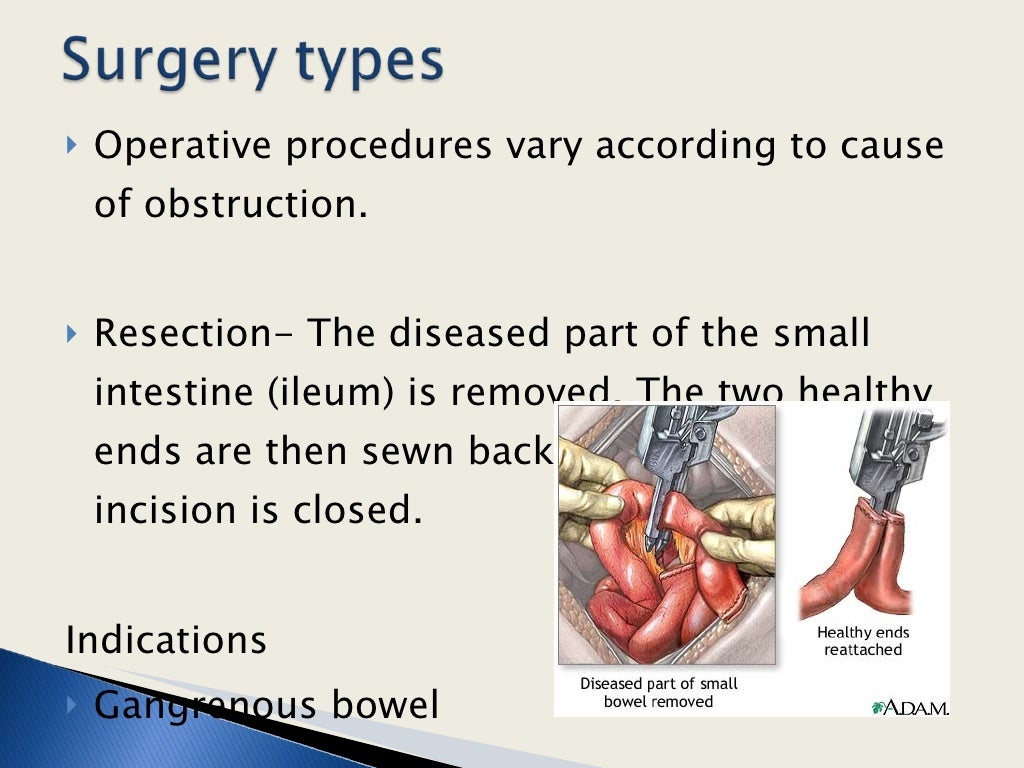Management Of Intestinal Obstruction