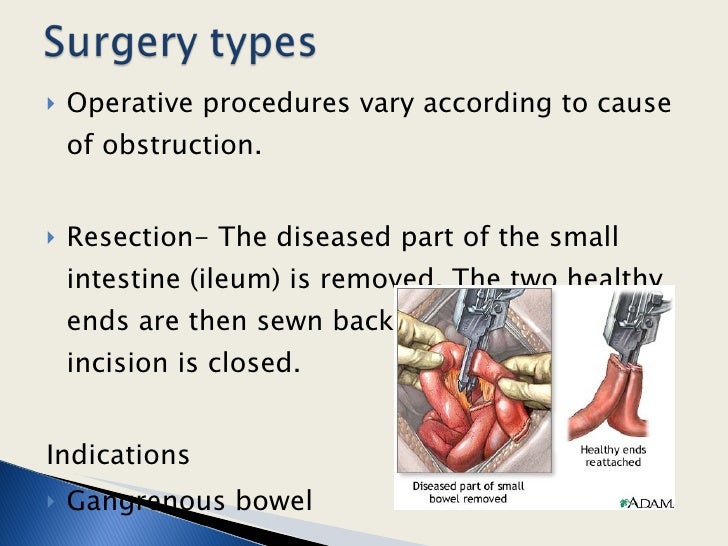 Management Of Intestinal Obstruction
