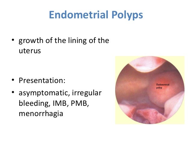 Management of menorrhagia