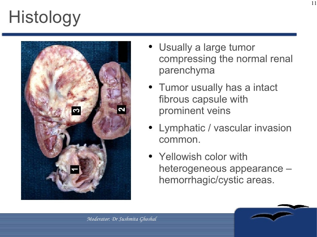 Management Of Wilms Tumors