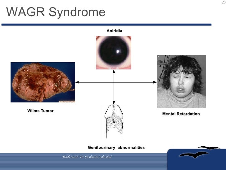 Management of Wilms Tumors