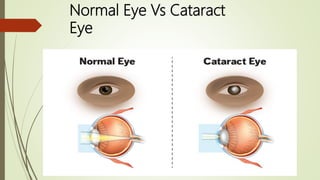 Management%20of%20cataract | PPTX