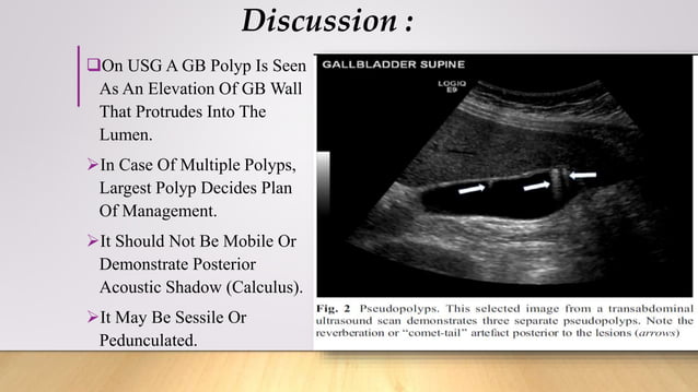 Management and follow up of gallbladder polyps | PPTX