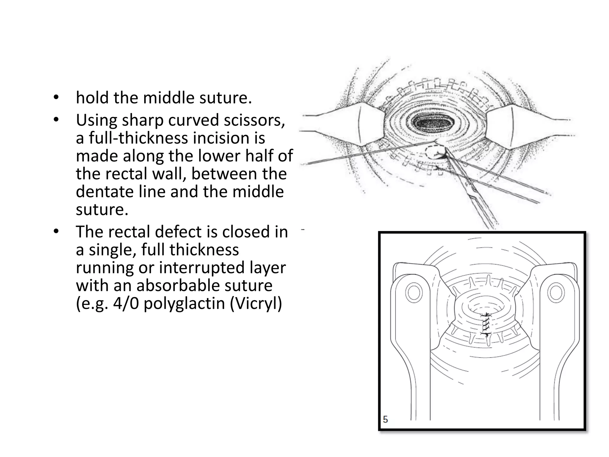 Management and surgical procedures of Hirschsprung disease | PPTX