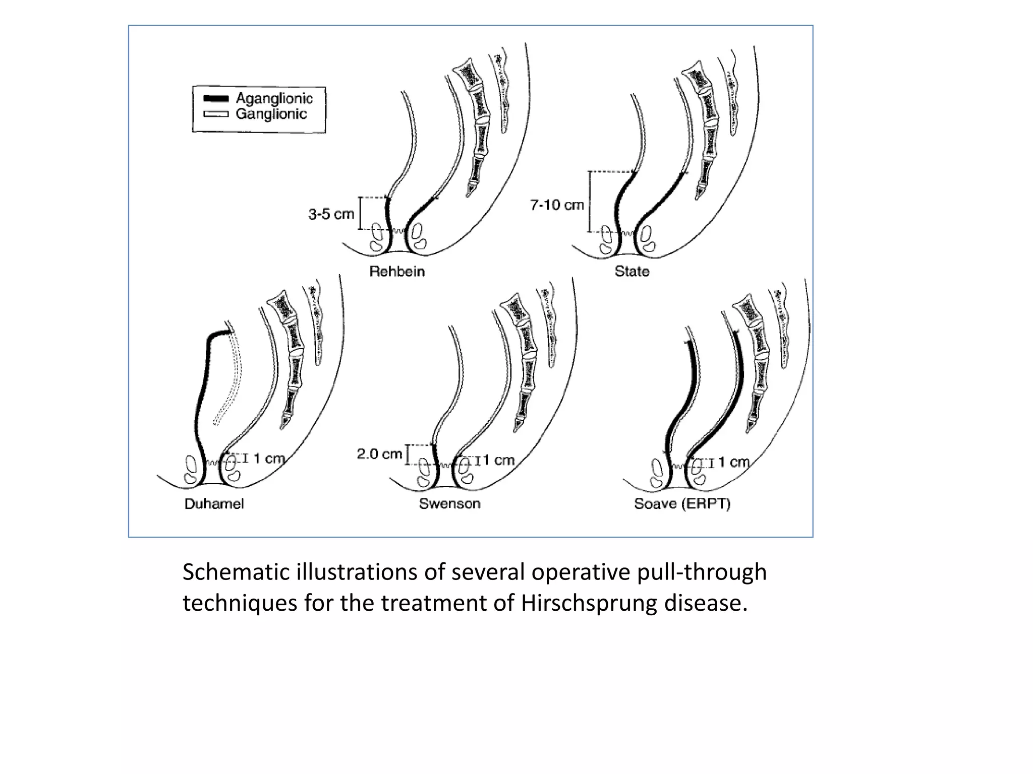 Management and surgical procedures of Hirschsprung disease | PPTX