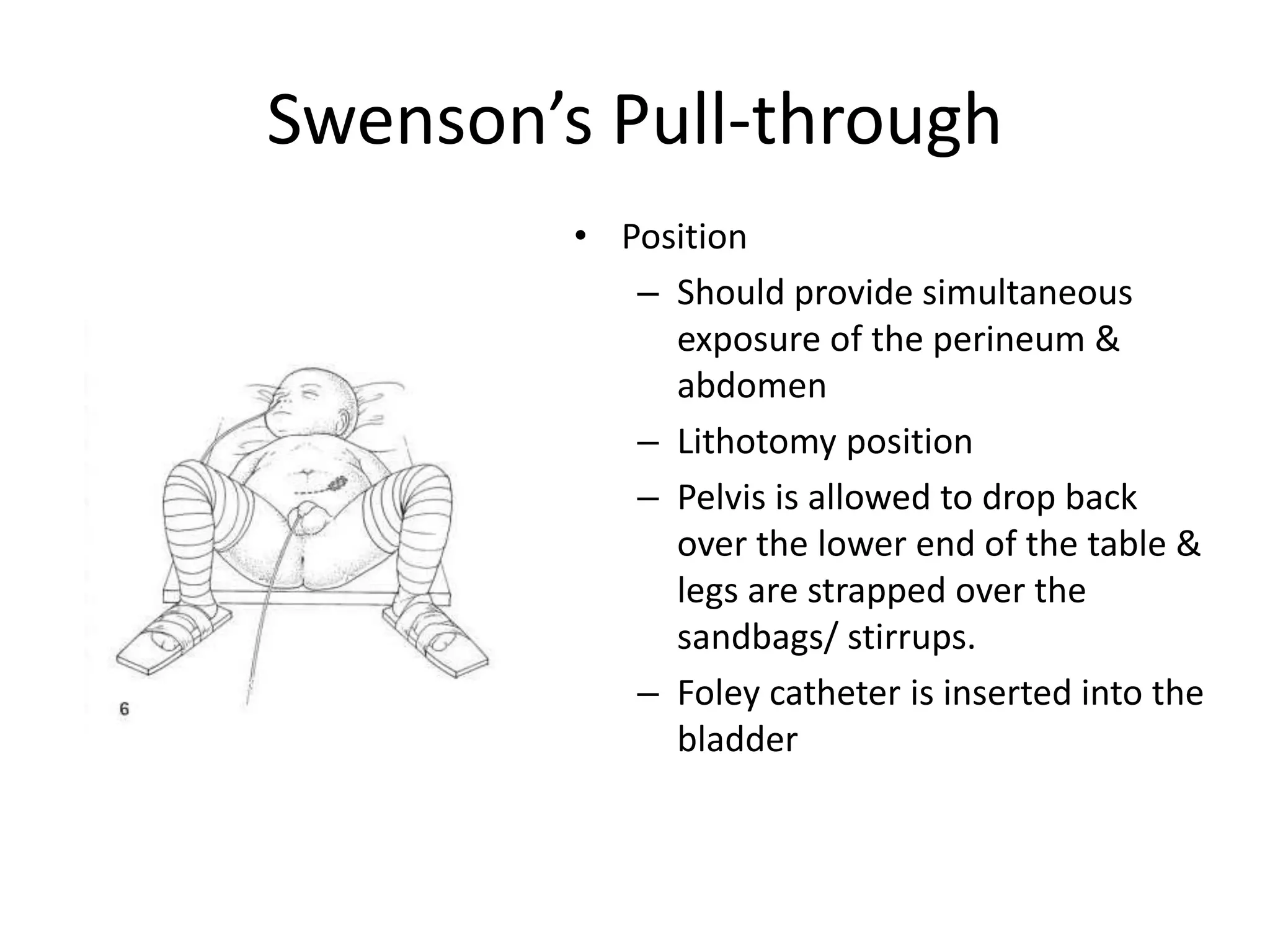 Management and surgical procedures of Hirschsprung disease | PPTX