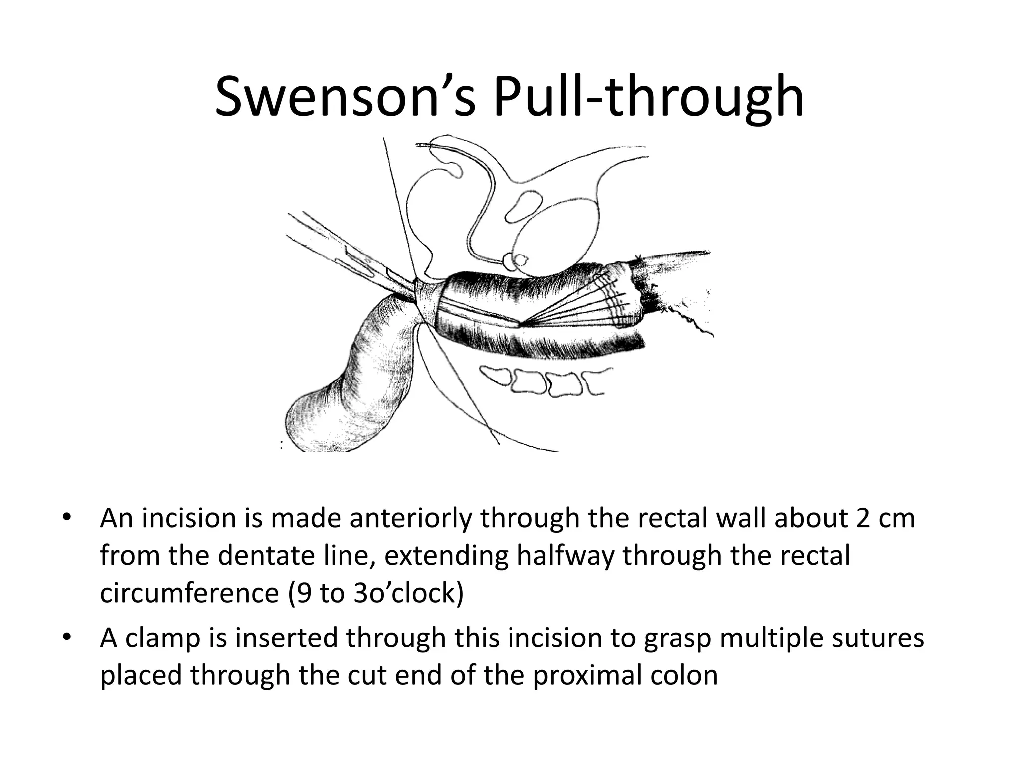 Management and surgical procedures of Hirschsprung disease | PPTX