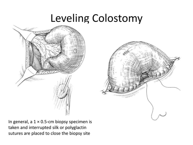 Management And Surgical Procedures Of Hirschsprung Disease