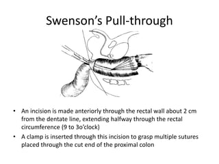 Management and surgical procedures of Hirschsprung disease | PPT