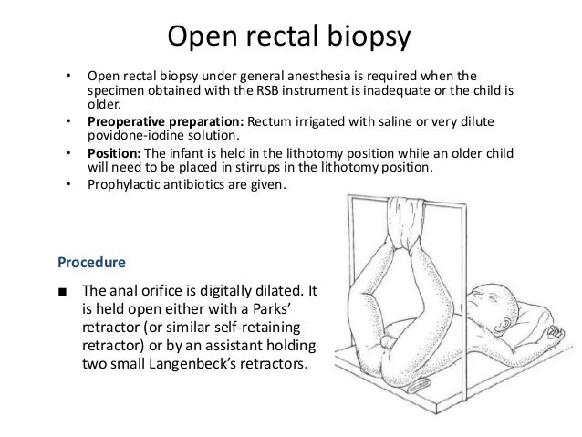 Management And Surgical Procedures Of Hirschsprung Disease