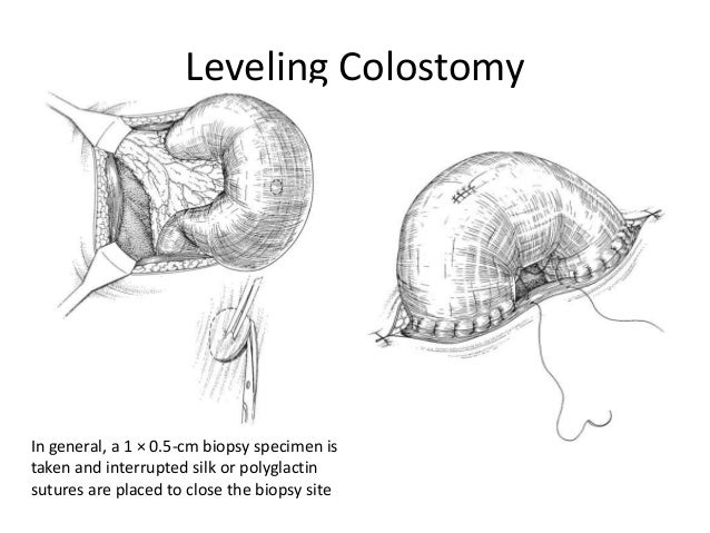 Management and surgical procedures of Hirschsprung disease