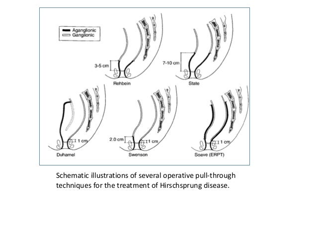 Management And Surgical Procedures Of Hirschsprung Disease