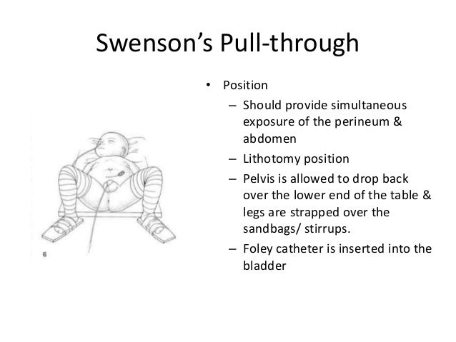 Management and surgical procedures of Hirschsprung disease