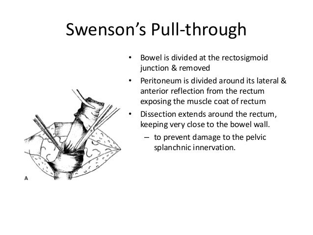 Management and surgical procedures of Hirschsprung disease