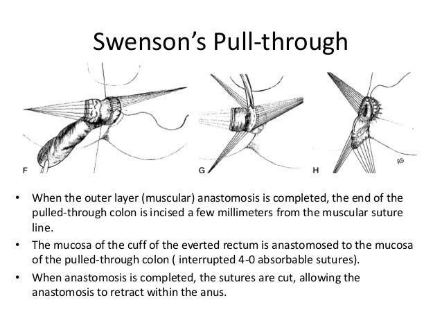 Management and surgical procedures of Hirschsprung disease