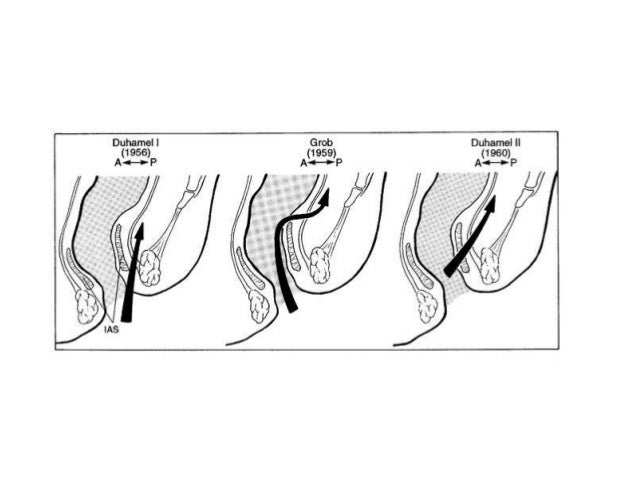 Management And Surgical Procedures Of Hirschsprung Disease