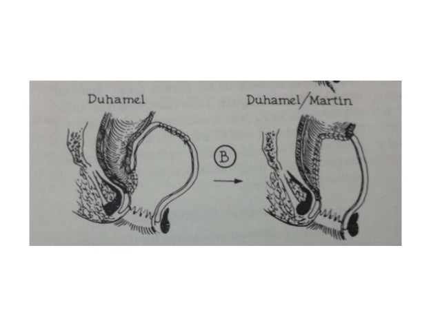 Management and surgical procedures of Hirschsprung disease