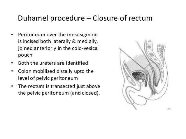 Management and surgical procedures of Hirschsprung disease
