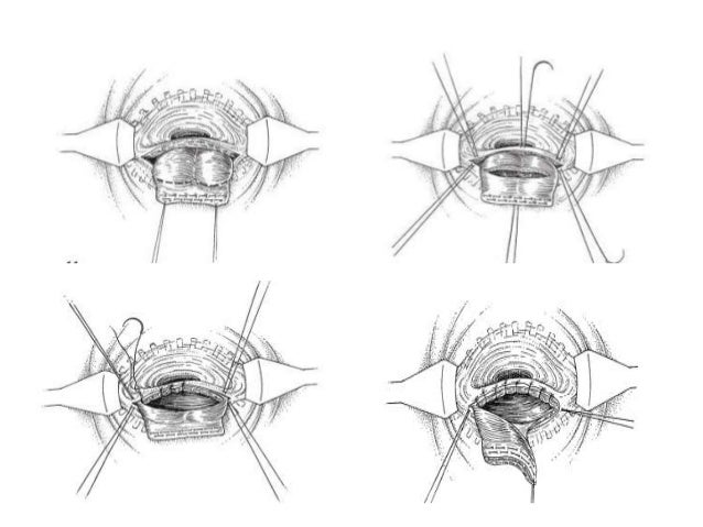 Management and surgical procedures of Hirschsprung disease