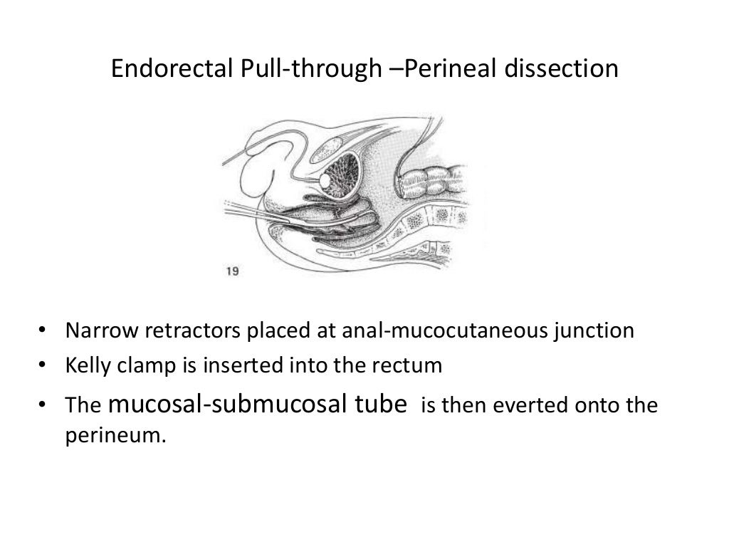 Management And Surgical Procedures Of Hirschsprung Disease
