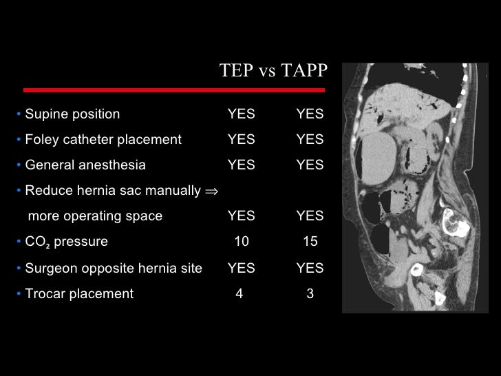 Management of Giant Scrotal Hernia