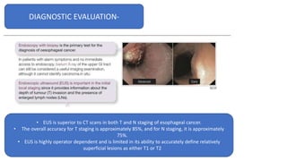 Management Guideline in Esophageal cancer.pptx