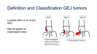 MANAGEMENT OF GEJ GASTRO ESOPHAGEAL JUNCTION (3).pptx