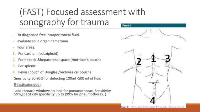 Management of abdominal trauma | PPTX | First Aid | Injuries