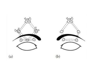 Management of a Case of Ptosis management of case of ptosis | PPTX