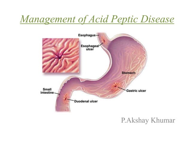 Management of Acid Peptic Disease | PPT