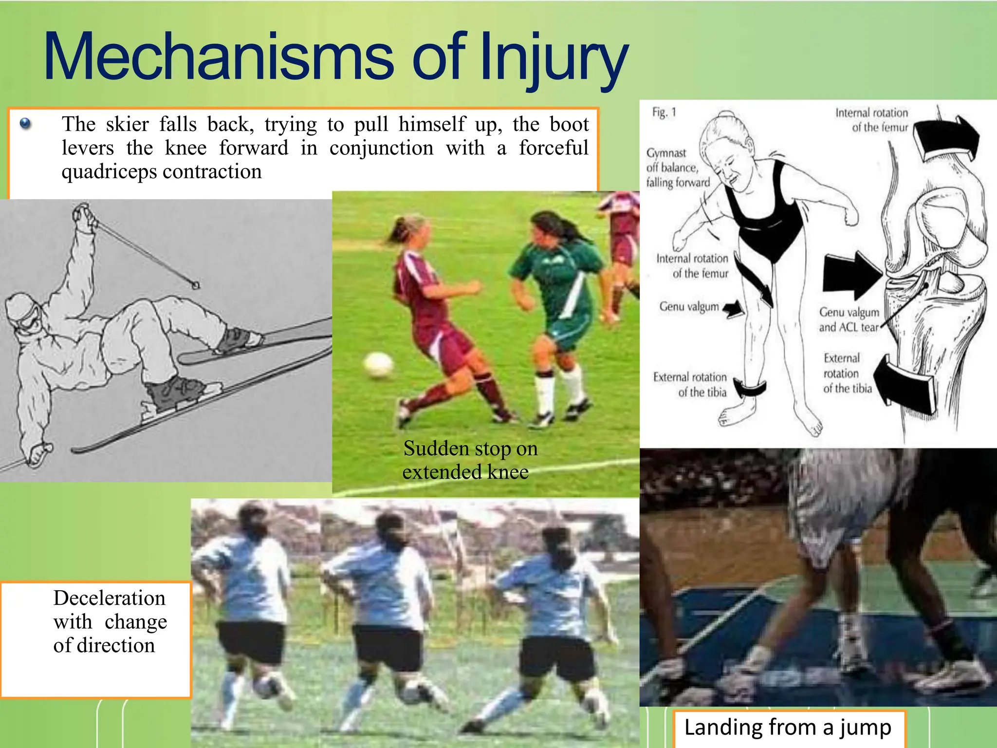 Management of ACL injury .pptx