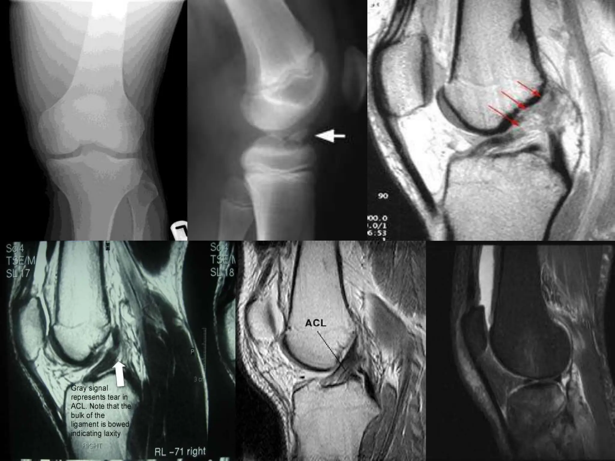 Management of ACL injury .pptx