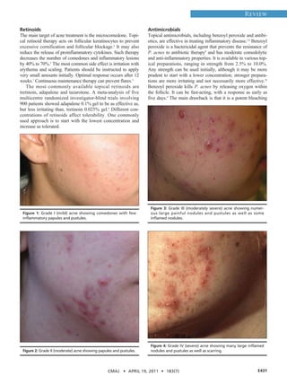 Management of acne | PDF