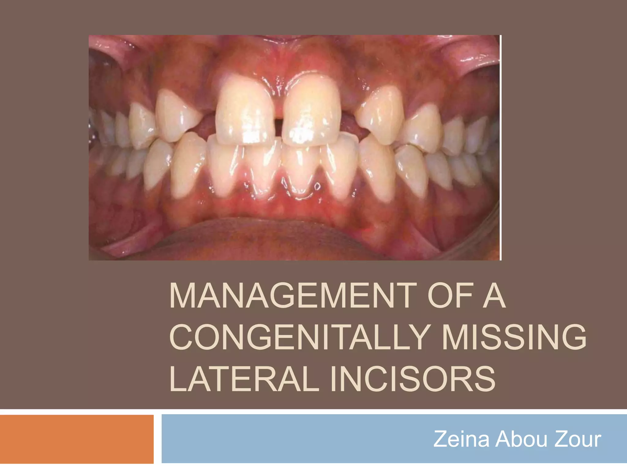 Management of a congenitally missing lateral incisors | PPTX
