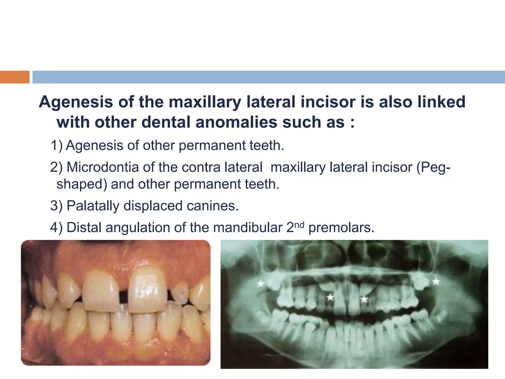 Management of a congenitally missing lateral incisors | PPTX