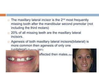 Management of a congenitally missing lateral incisors | PPTX