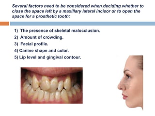 Management of a congenitally missing lateral incisors | PPTX