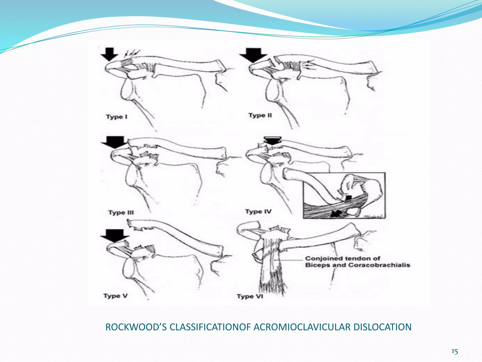 Management of acromioclavicular joint dislocations | PPTX