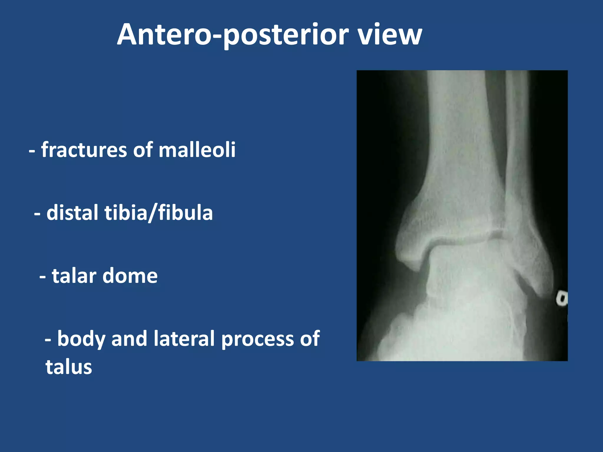 Management of acute ankle fractures | PPTX