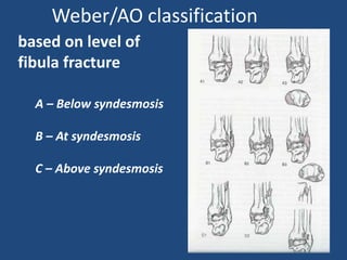 Management of acute ankle fractures | PPTX
