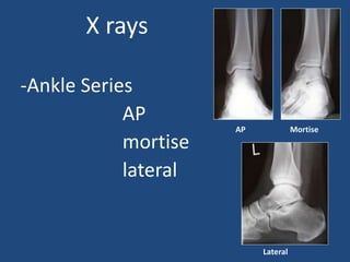 Management of acute ankle fractures | PPTX