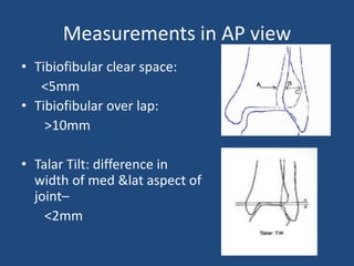 Management of acute ankle fractures | PPTX