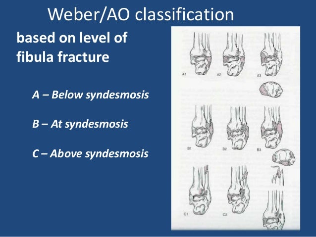 Management of acute ankle fractures