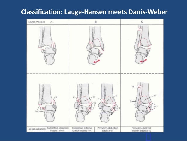 Management of acute ankle fractures