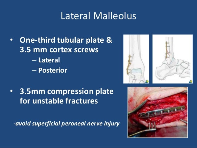 Management of acute ankle fractures