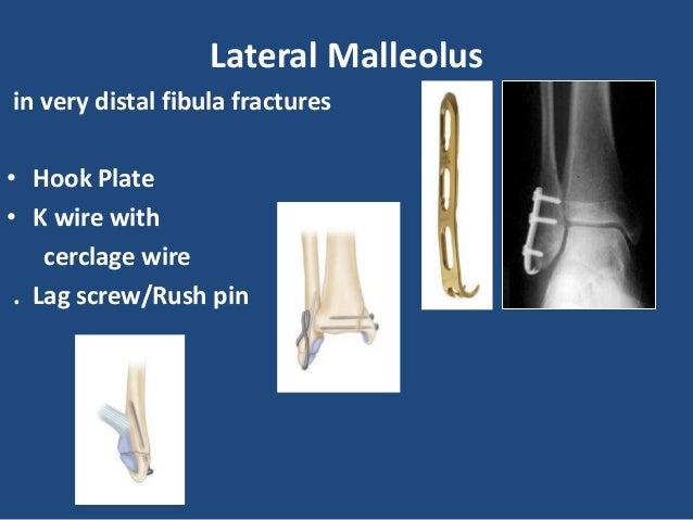 Management of acute ankle fractures