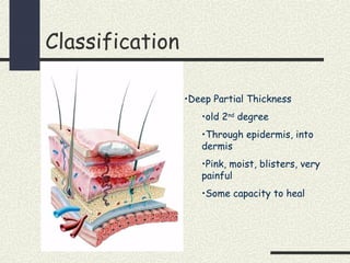 Management of acute burns | PPS
